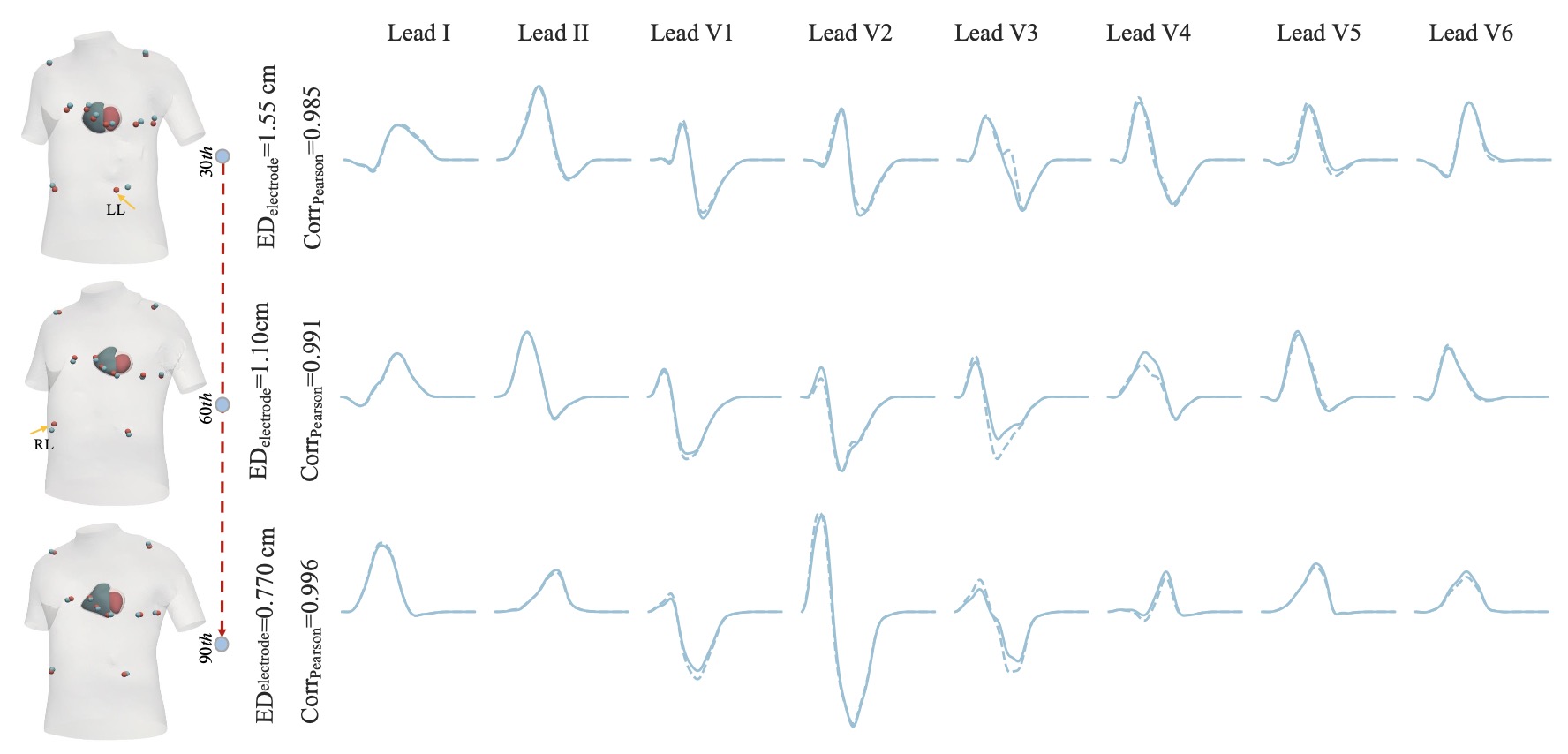 Personalized Topology-Informed Localization of Standard 12-Lead ECG Electrode Placement from ...