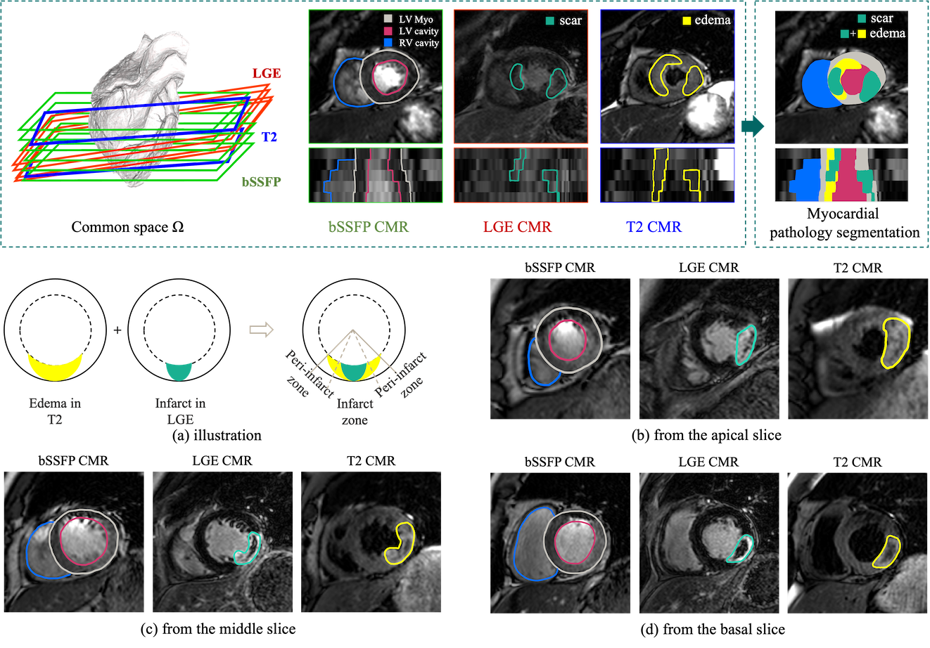 MyoPS: A Benchmark of Myocardial Pathology Segmentation Combining Three-Sequence Cardiac ...