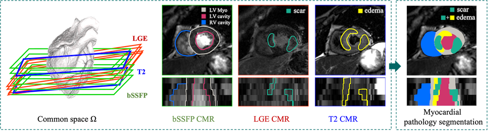 MyoPS: A Benchmark of Myocardial Pathology Segmentation Combining Three-Sequence Cardiac ...