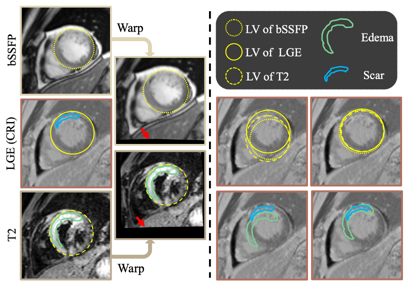 Aligning Multi-Sequence CMR Towards Fully Automated Myocardial Pathology Segmentation